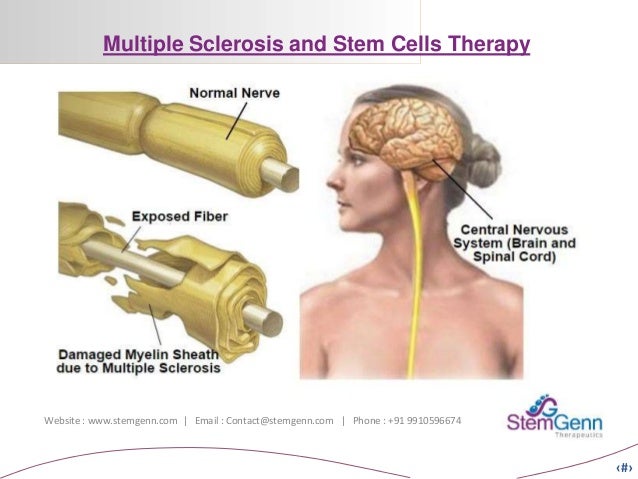 Multiple Sclerosis And Stem Cells Therapy