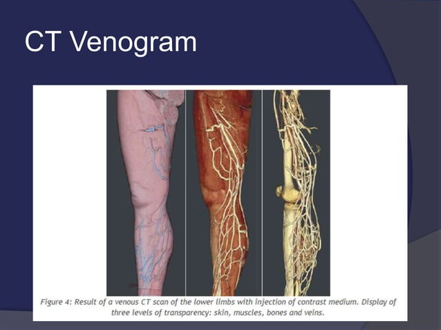 Lower Limb Venous Drainage , Lower Limb Anatomy & Joint Structure ...