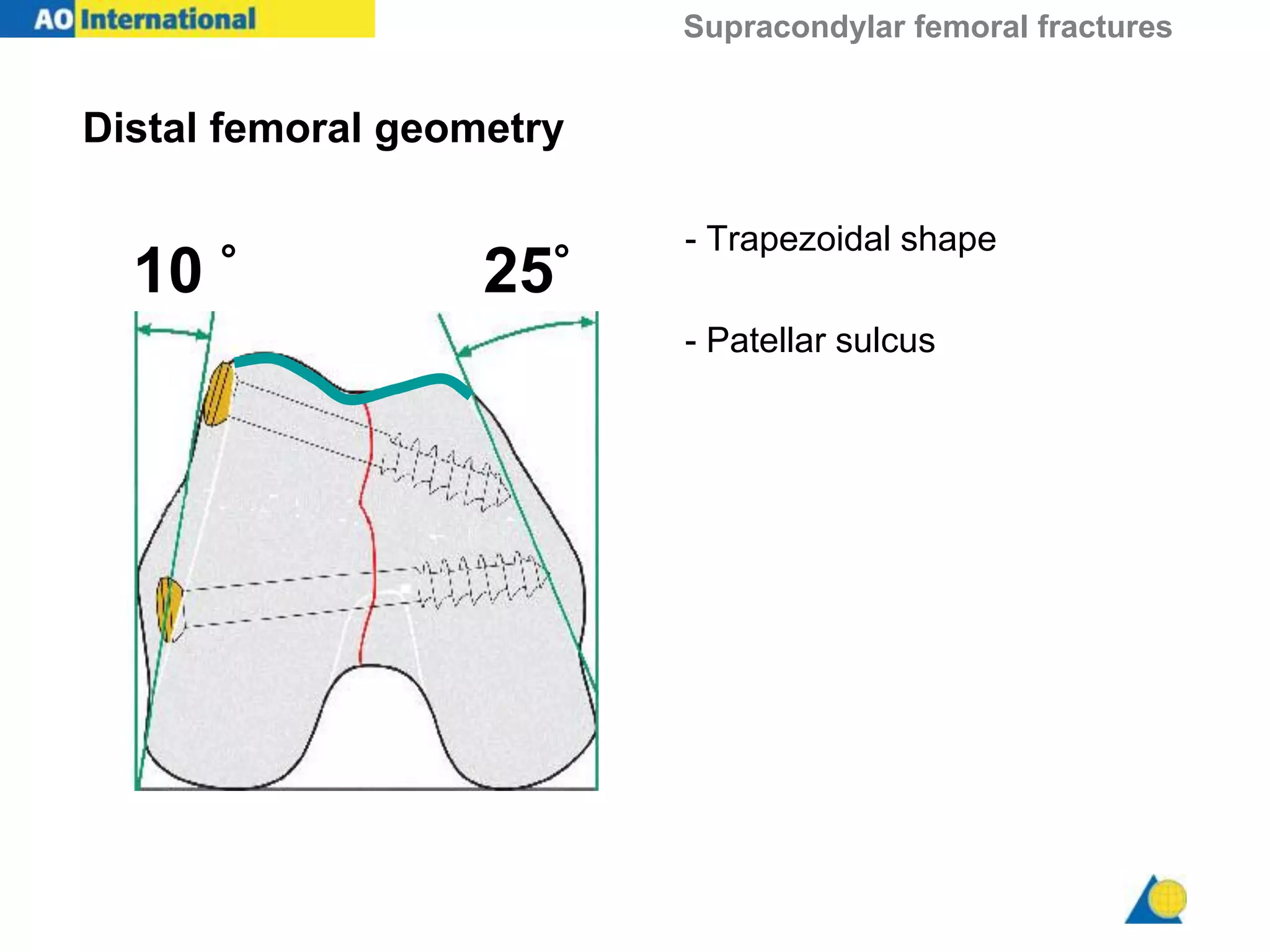 distal femur fracture | PDF