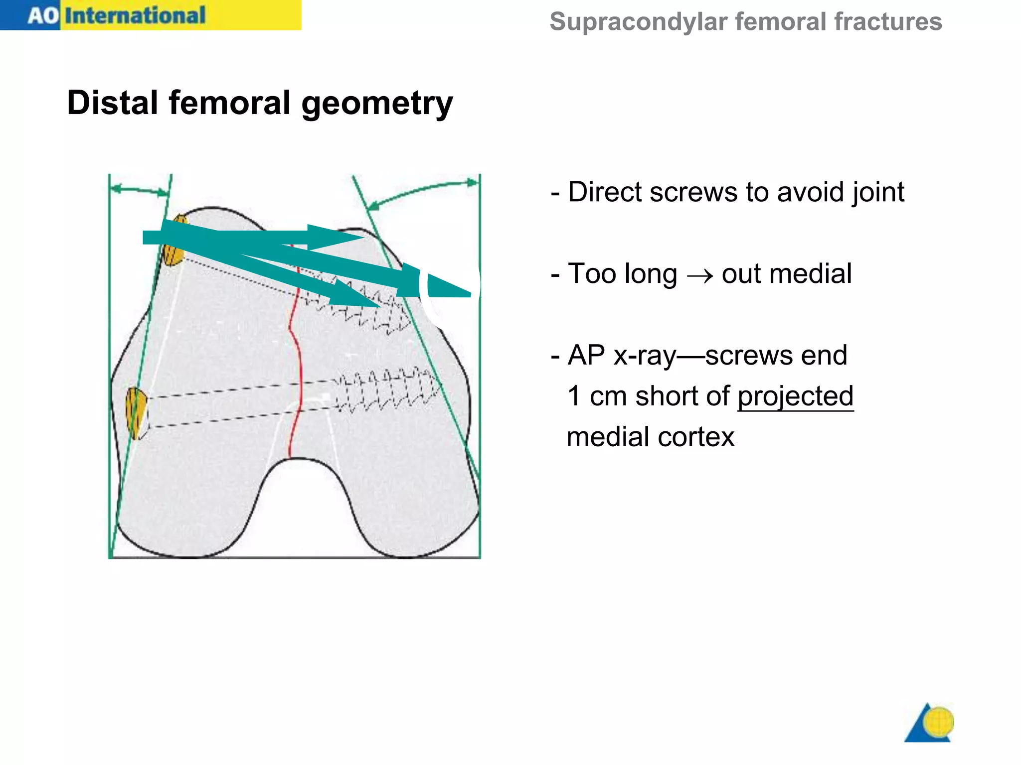 distal femur fracture | PDF