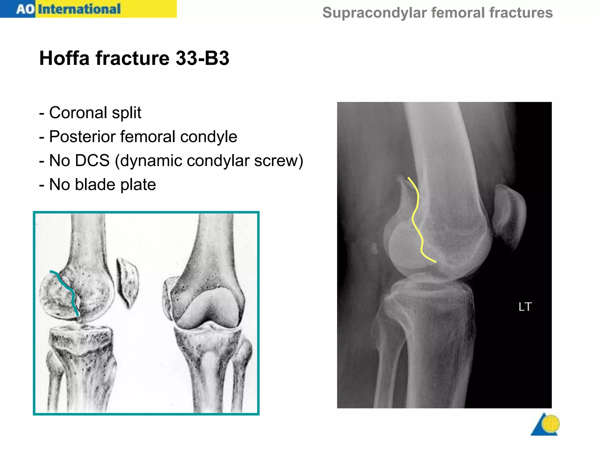 distal femur fracture | PDF