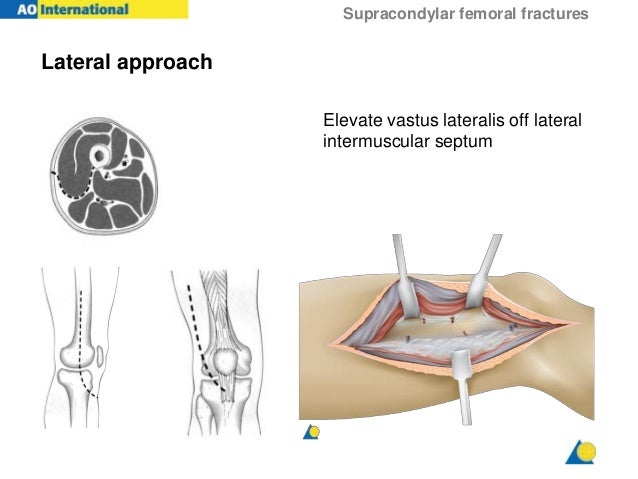distal femur fracture