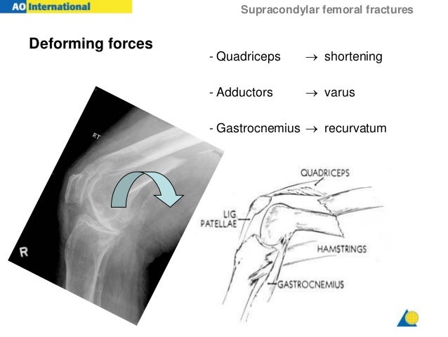 distal femur fracture