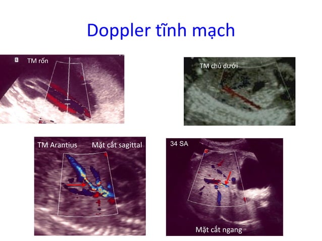 21. Sieu am doppler trong chan doan va theo doi thai cham phat trien ...