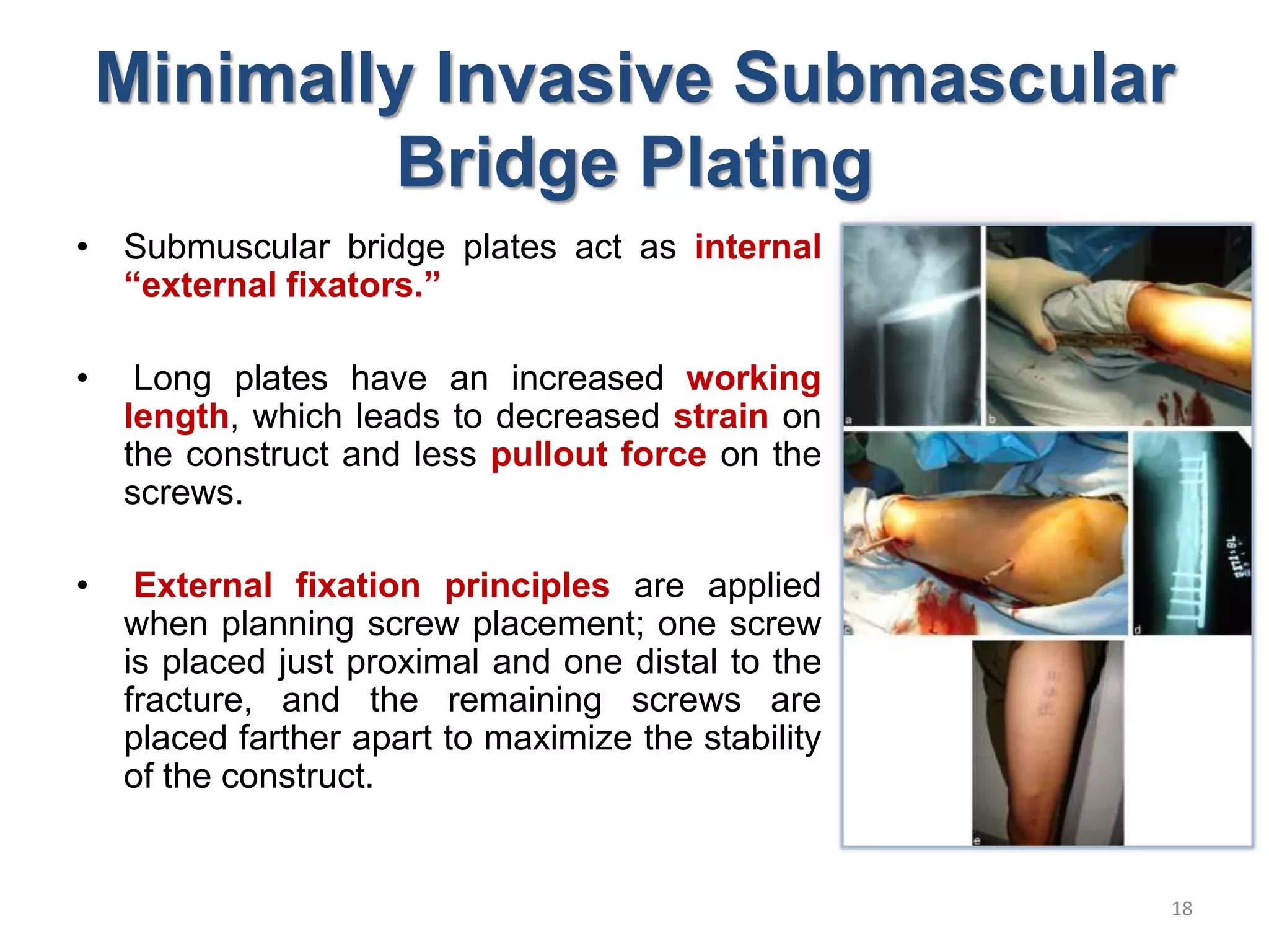 Minimally Invasive Plate Osteosynthesis in pediateric femoral shaft ...