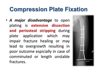 Minimally Invasive Plate Osteosynthesis in pediateric femoral shaft ...