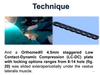 Minimally Invasive Plate Osteosynthesis in pediateric femoral shaft ...