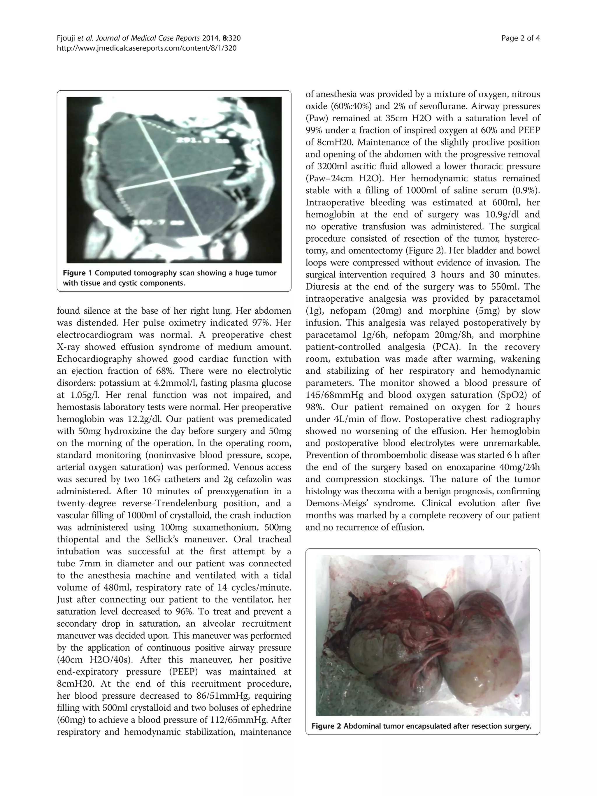 21. anesthetic considerations in demons meigs' syndrome | PDF