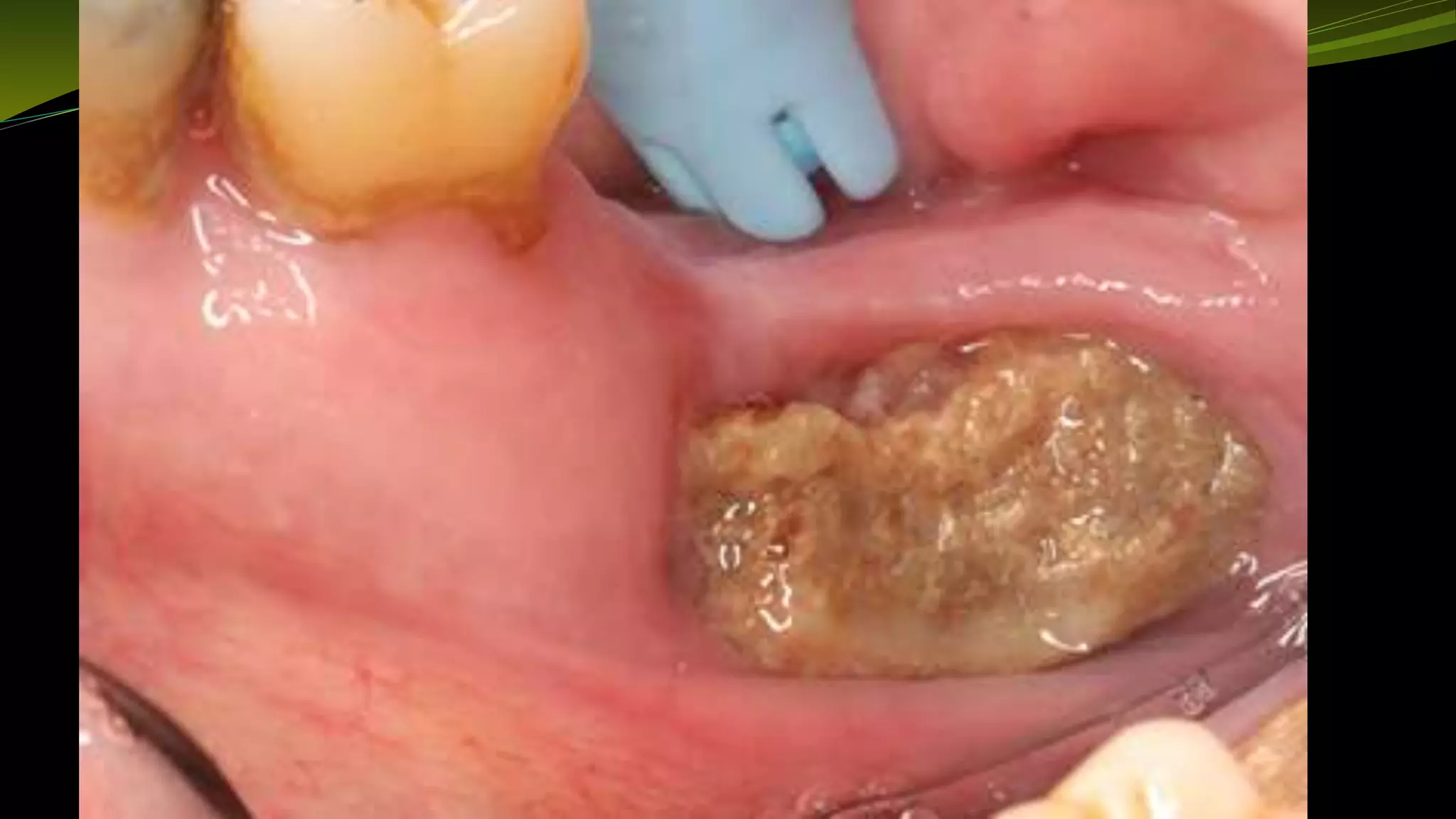 Osteonecrosis of the Jaws (BRONJ, MRONJ) | PPTX