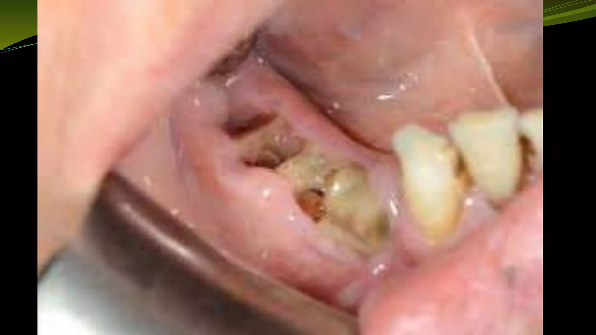 Osteonecrosis of the Jaws (BRONJ, MRONJ) | PPTX