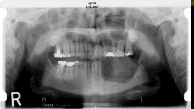 Osteonecrosis of the Jaws (BRONJ, MRONJ) | PPTX