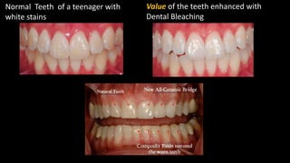 Color of Natural Teeth and shade selection in dentistry. | PPTX
