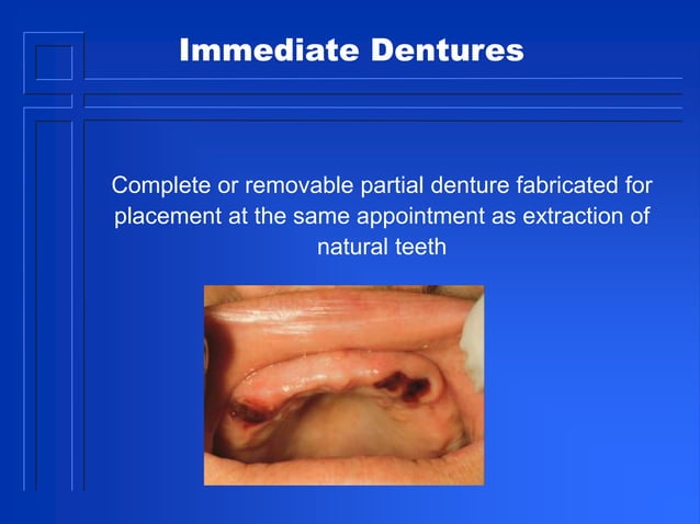 21. Immediate Denture and complete dentures.ppt