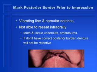 21. Immediate Denture and complete dentures.ppt