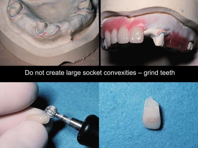 21. Immediate Denture and complete dentures.ppt