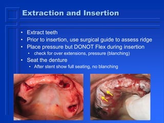 21. Immediate Denture and complete dentures.ppt
