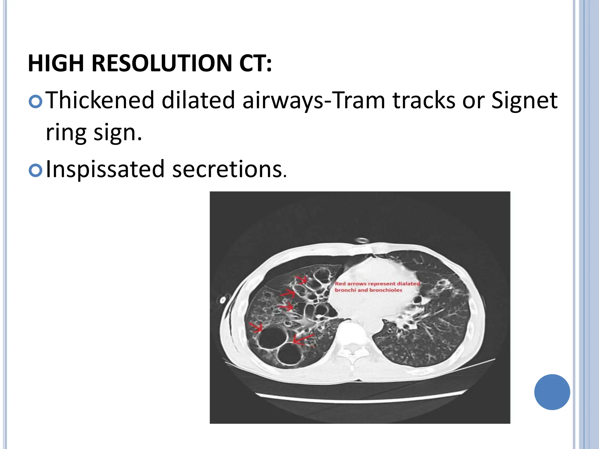 21.BRONCHIECTASIS.pptx mbbss respiratory | PPTX