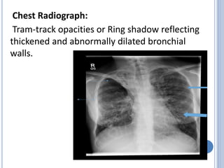 21.BRONCHIECTASIS.pptx mbbss respiratory | PPTX