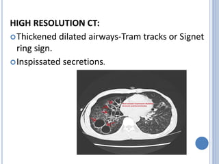 21.BRONCHIECTASIS.pptx mbbss respiratory | PPTX