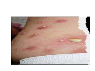 Neonatal Impetigo for Paediatrics and Neonates | PPTX