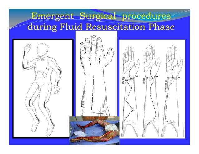Early excision and grafting for burns | PDF