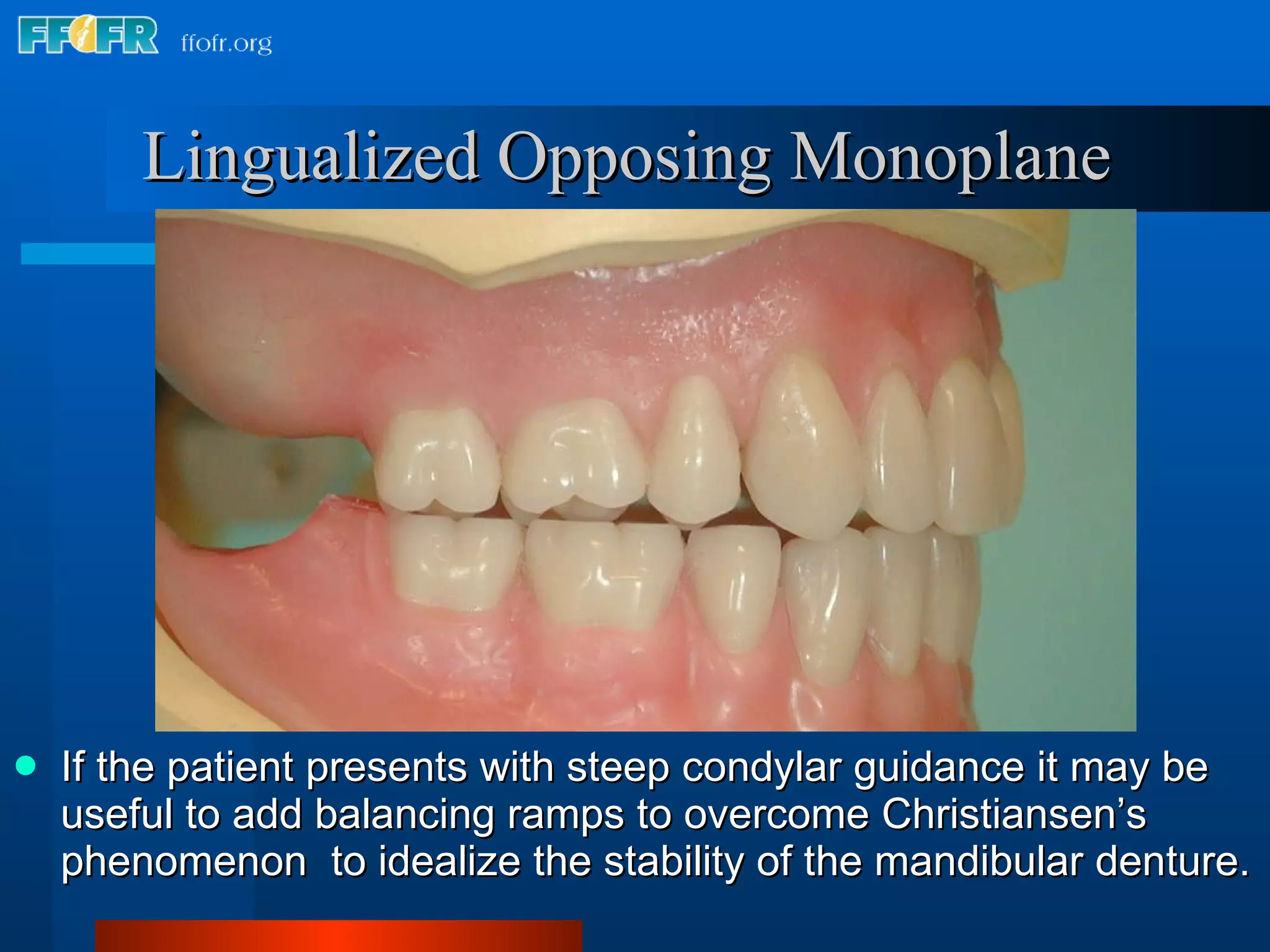 21.occlusal schemes monoplane with balancing ramps | PPT
