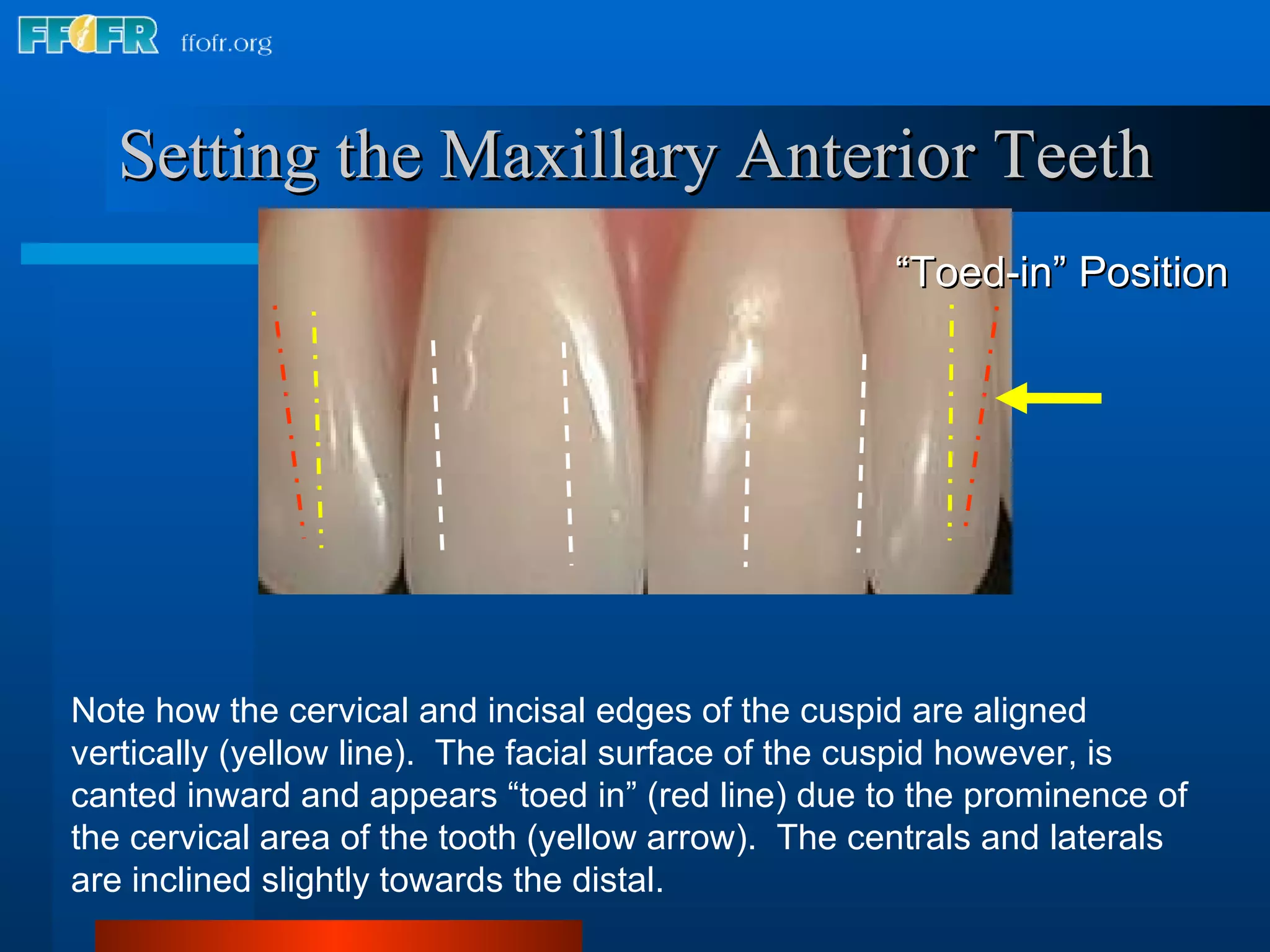 21.occlusal schemes monoplane with balancing ramps | PPT