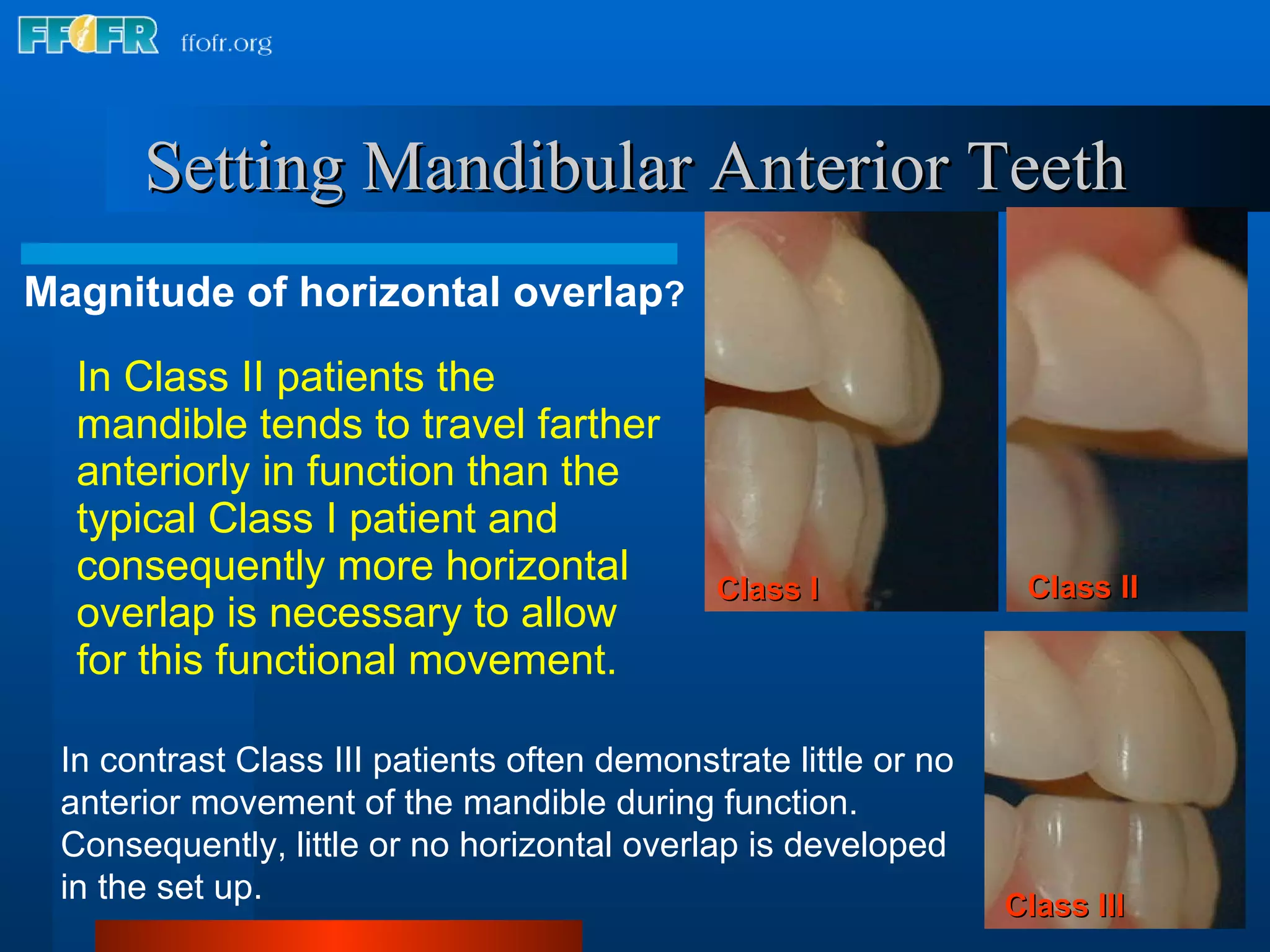21.occlusal schemes monoplane with balancing ramps | PPT