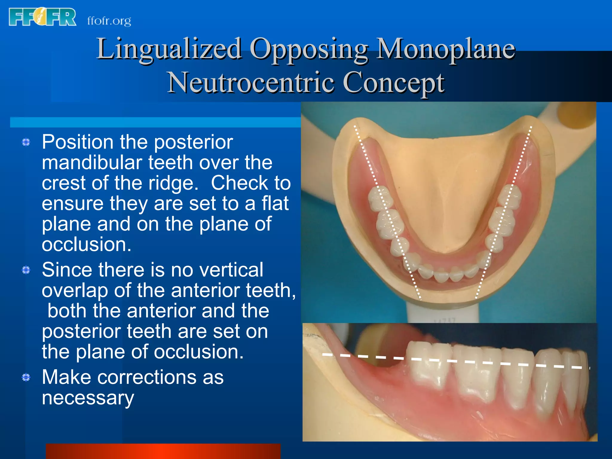 21.occlusal schemes monoplane with balancing ramps | PPT