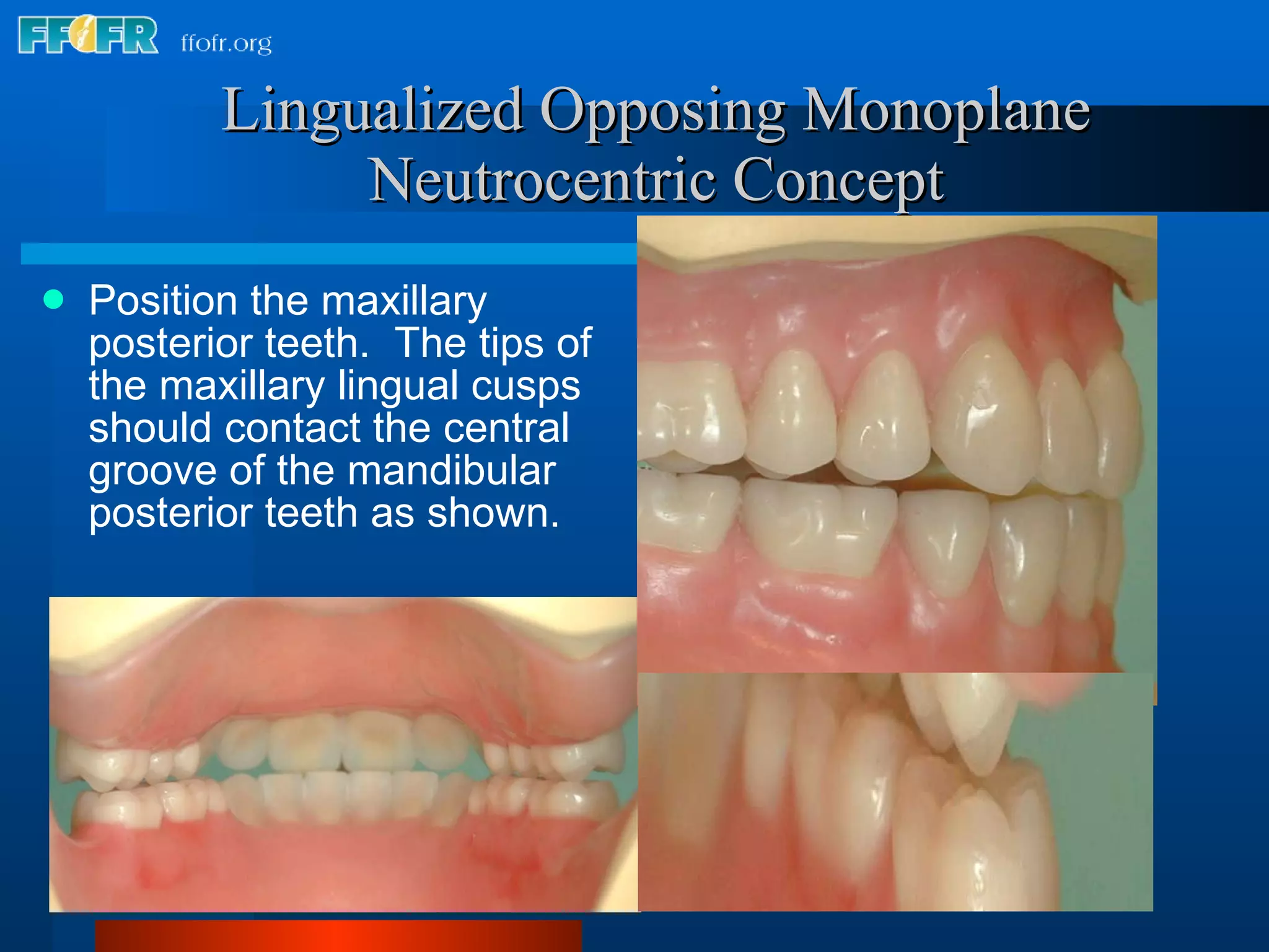 21.occlusal schemes monoplane with balancing ramps | PPT