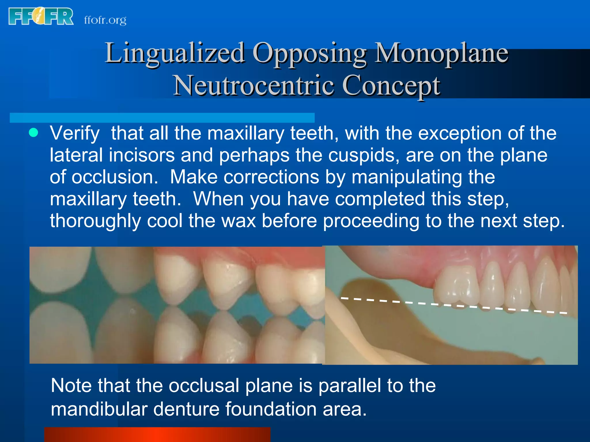 21.occlusal schemes monoplane with balancing ramps | PPT