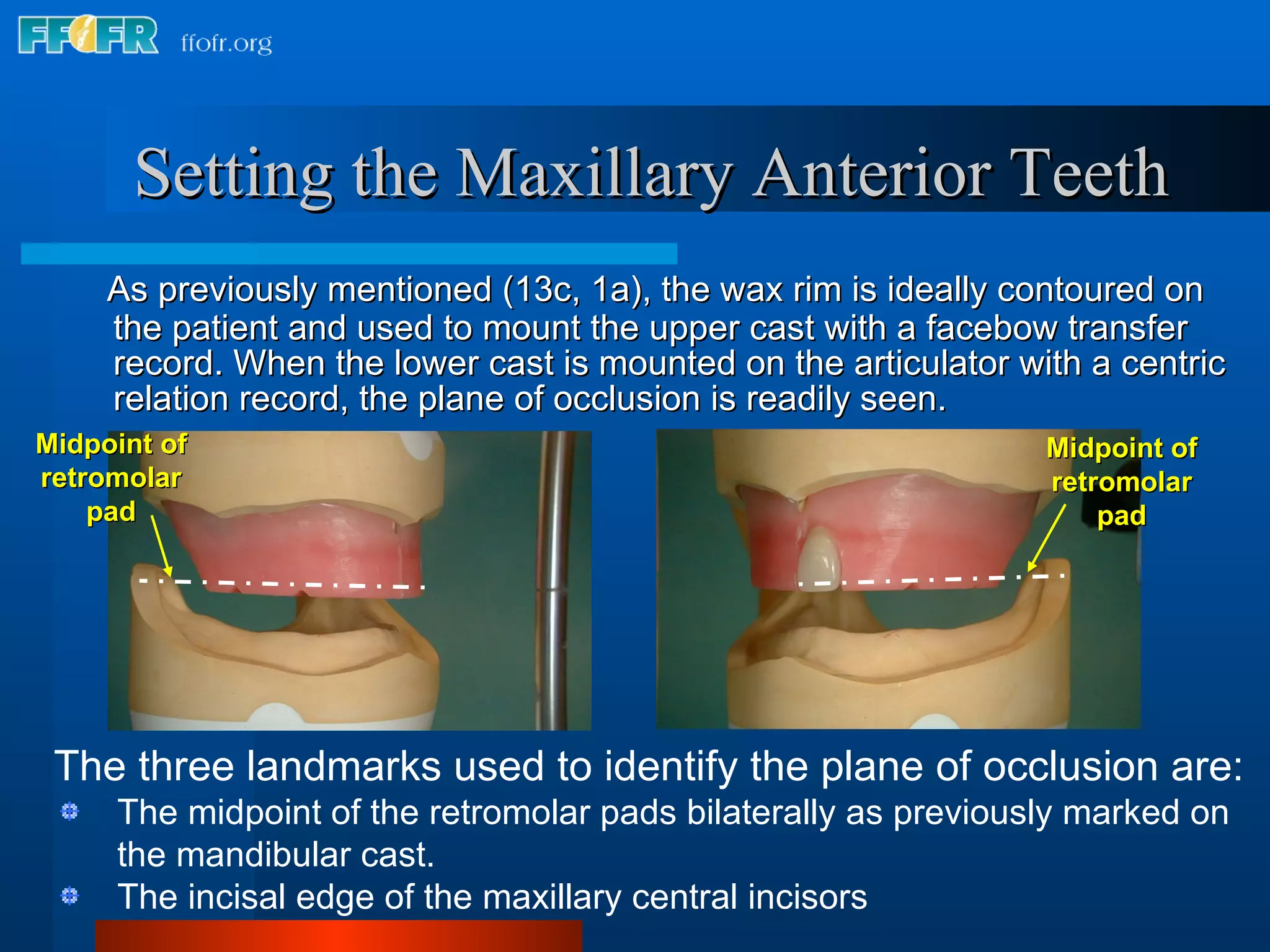 21.occlusal schemes monoplane with balancing ramps | PPT