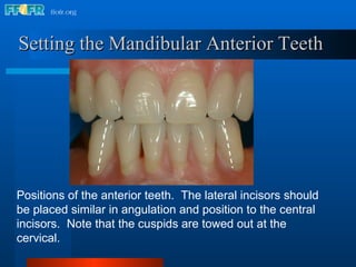 21.occlusal schemes monoplane with balancing ramps | PPT