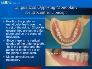 21.occlusal schemes monoplane with balancing ramps | PPT