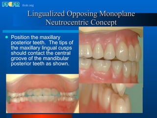 21.occlusal schemes monoplane with balancing ramps | PPT