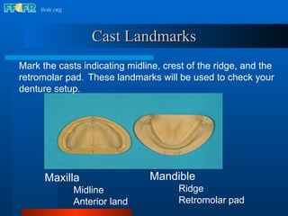 21.occlusal schemes monoplane with balancing ramps | PPT