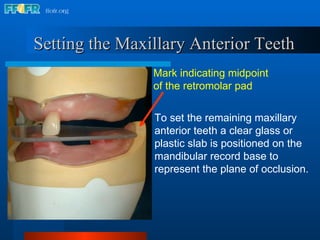 21.occlusal schemes monoplane with balancing ramps | PPT