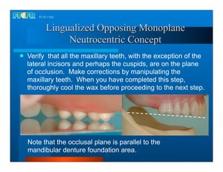 21.occlusal schemes monoplane with balancing ramps | PDF