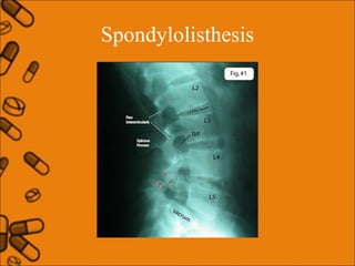 spondylolisthesis | PPT