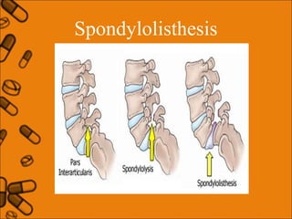 spondylolisthesis | PPT