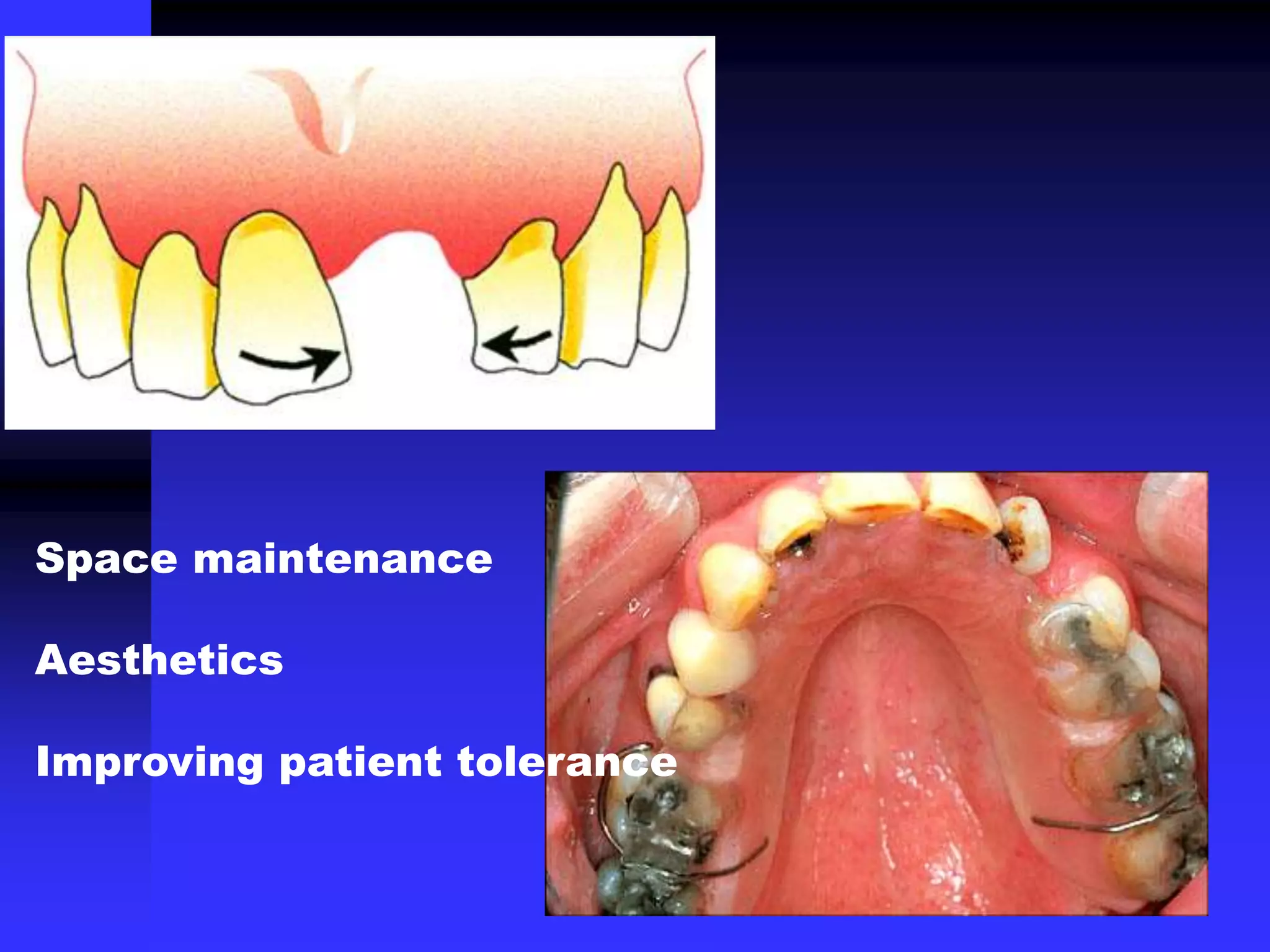 Temporary removable partial dentures | PPT