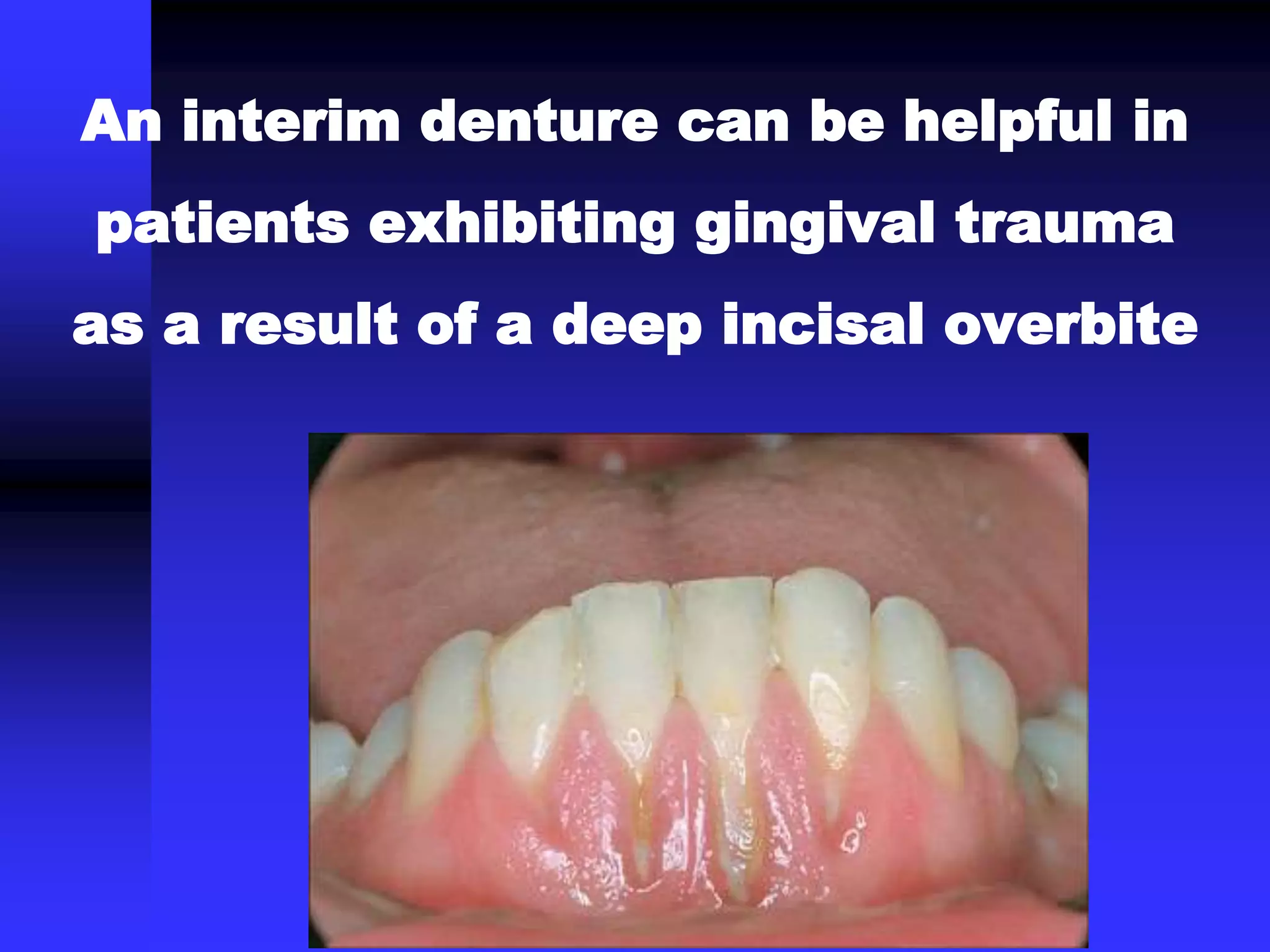 Temporary removable partial dentures | PPT