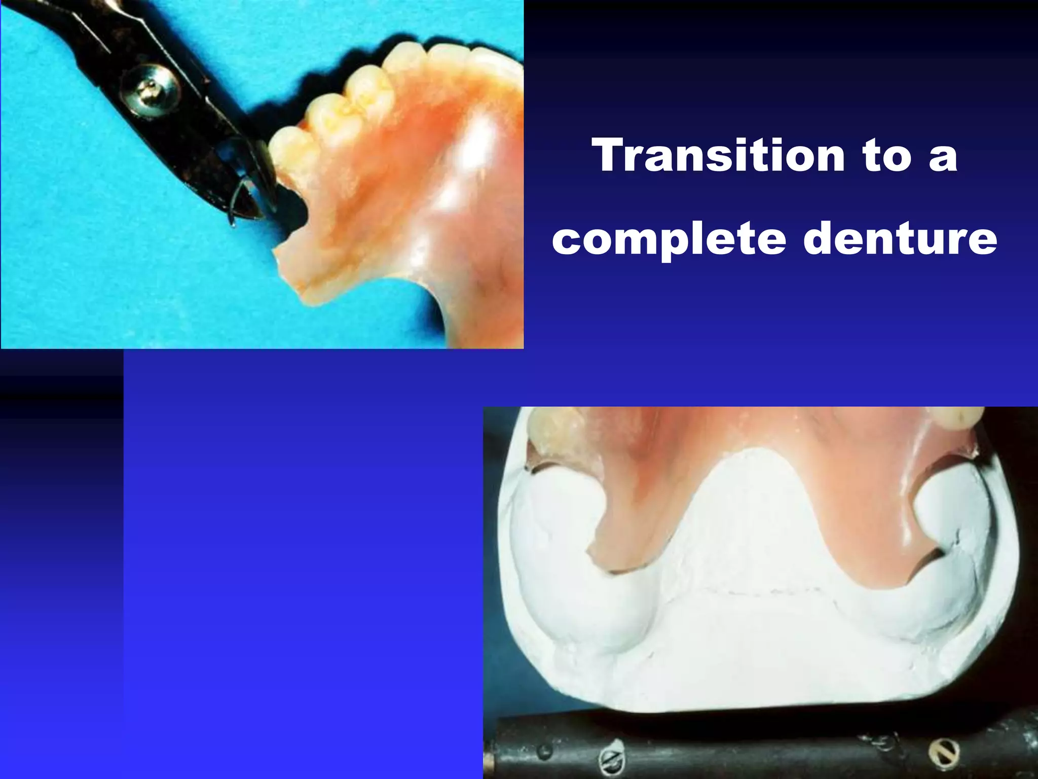 Temporary removable partial dentures | PPT