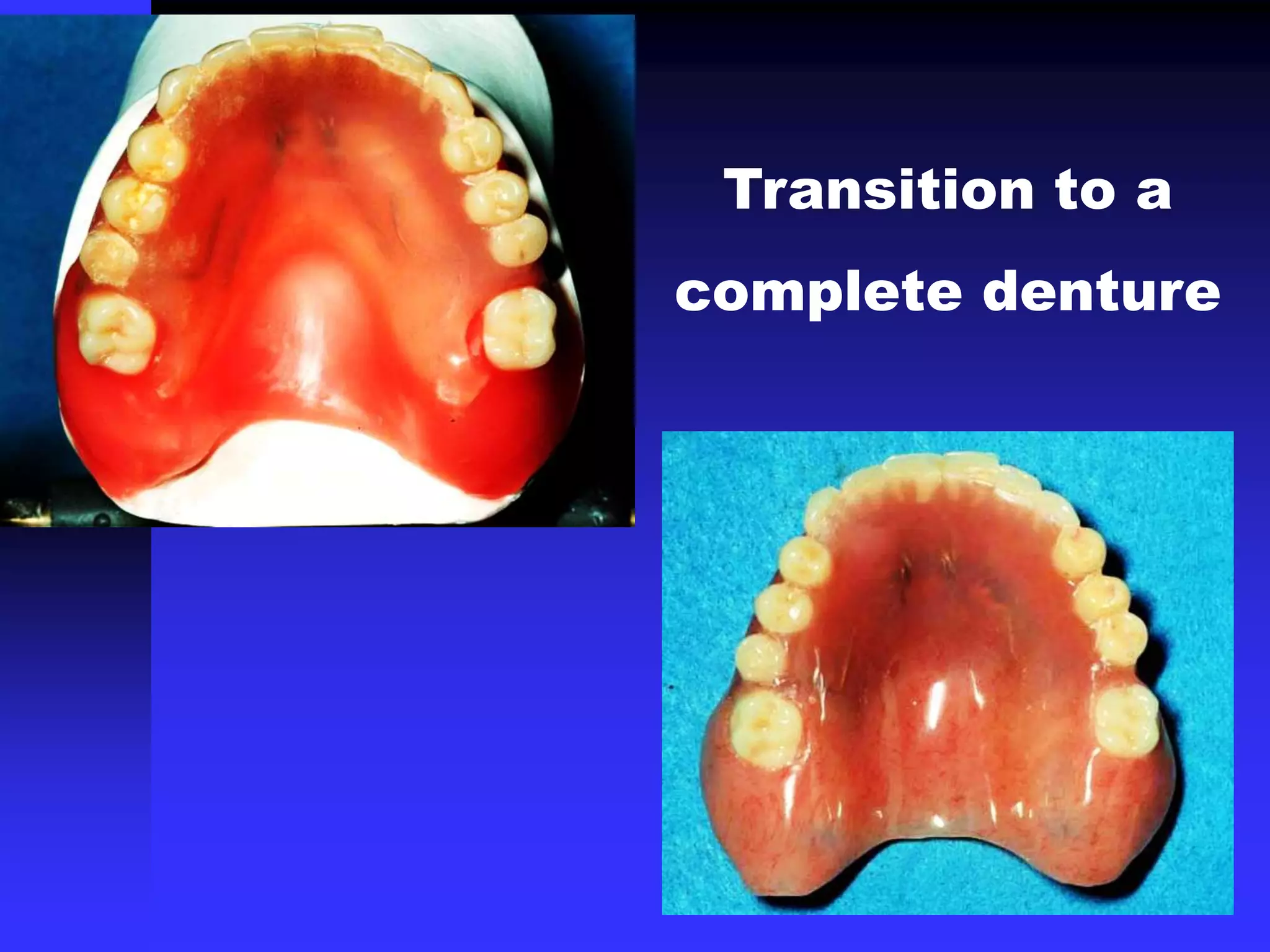 Temporary removable partial dentures | PPT