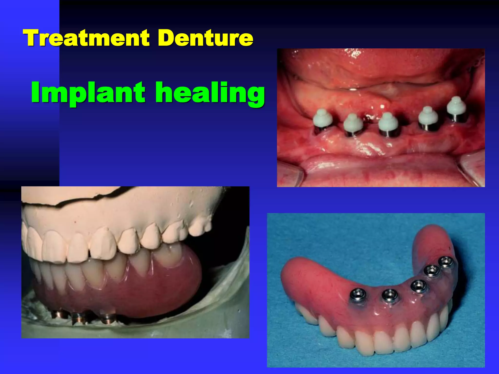 Temporary removable partial dentures | PPT