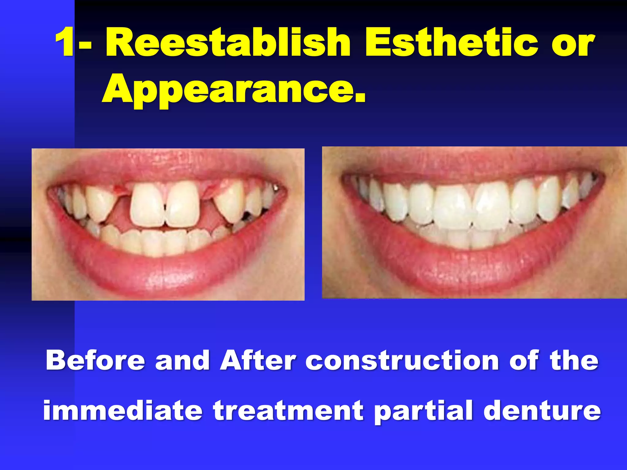 Temporary removable partial dentures | PPT
