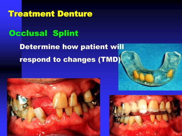 Temporary removable partial dentures | PPT | Dental Health | Diseases ...