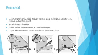 210126-Implant-Insertion-and-removal.pptx