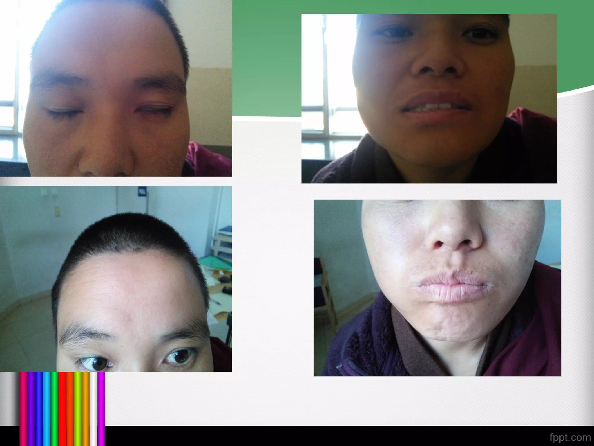 a case of lower motor neuron facial nerve palsy | PPT