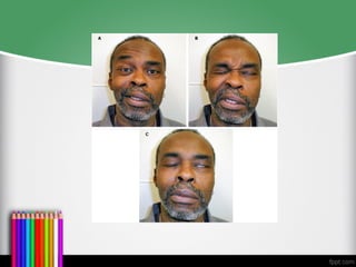 a case of lower motor neuron facial nerve palsy | PPT